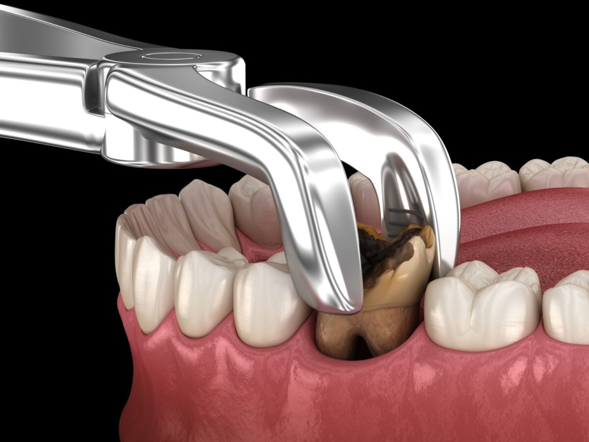 Tand of Kies Trekken – Veilig en Zorgvuldig bij Dental Art Laren